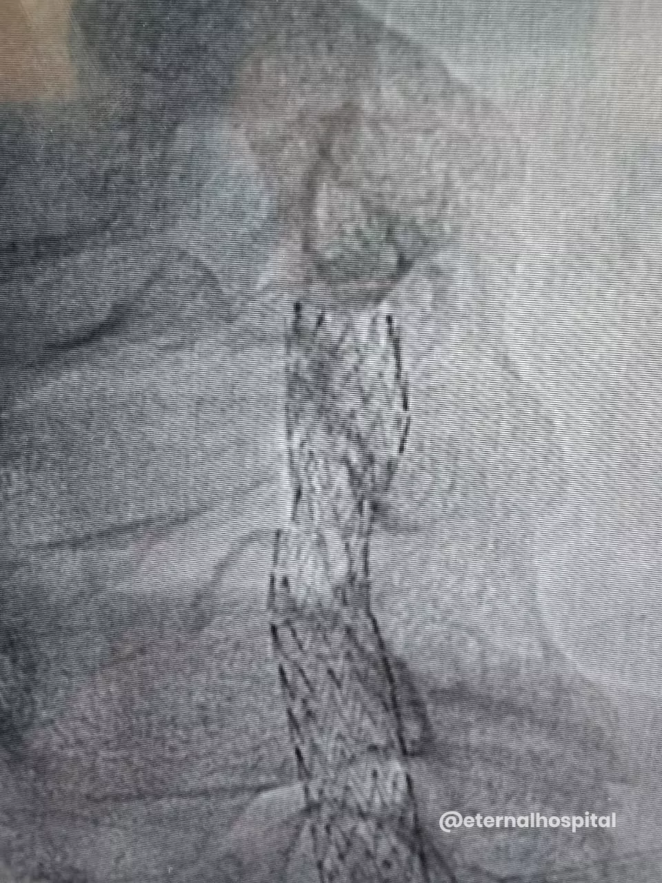 Carotid Stenting: Prevent Stroke & Restore Brain Blood Flow : Eternal ...
