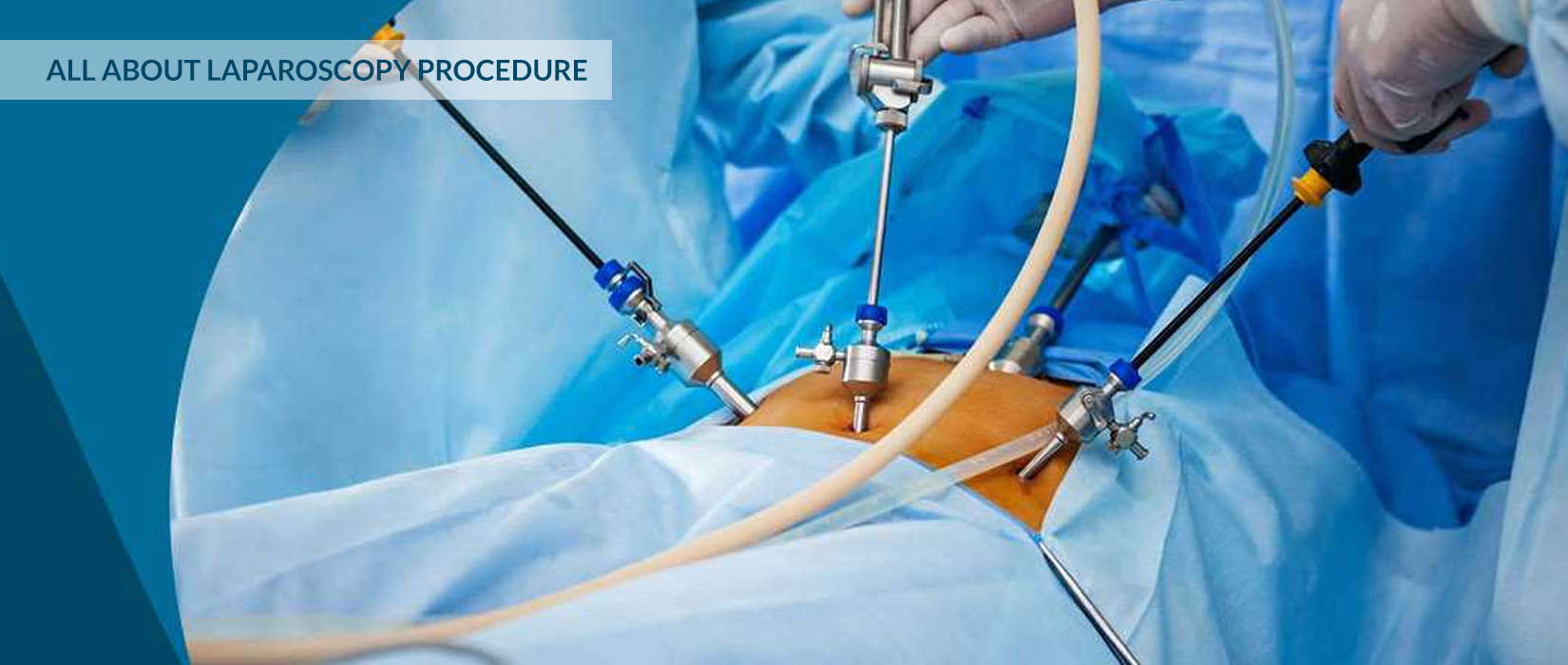 Everything You Must Know About Laparoscopic and General Surgeries ...